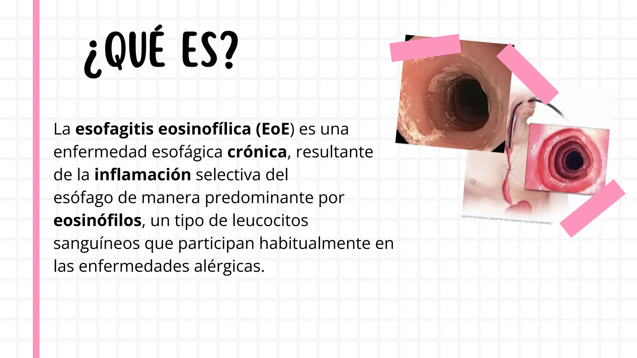 (2024-04-17)ESOFAGITIS EOSINOFILICA.ppt.pdf