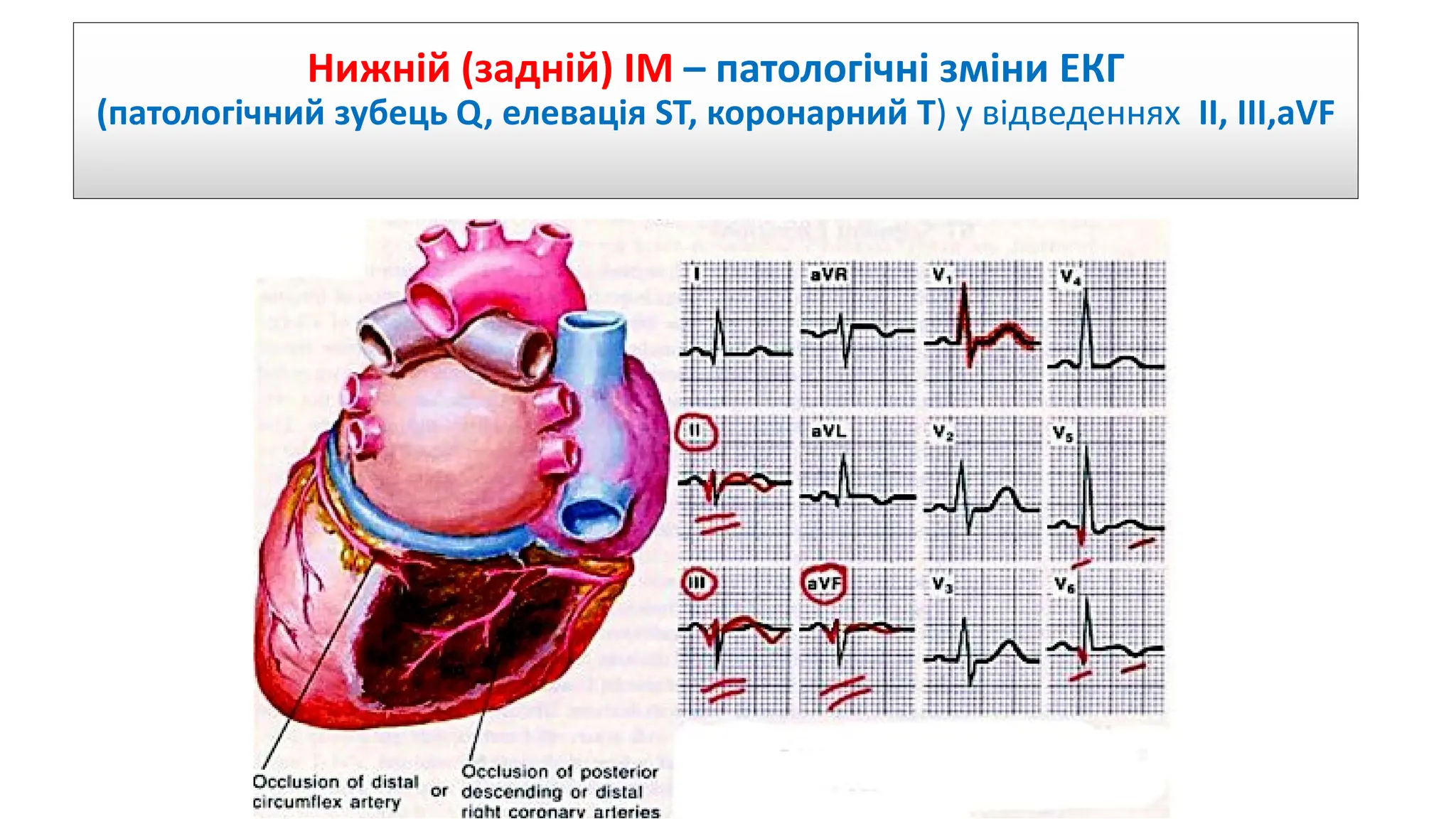 ISCHEMIC HEART DISEASE Angina. Myocardial infarction | PPT