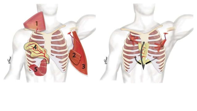 20240809 chest wall reconstruction.pptx20240809 chest wall ...