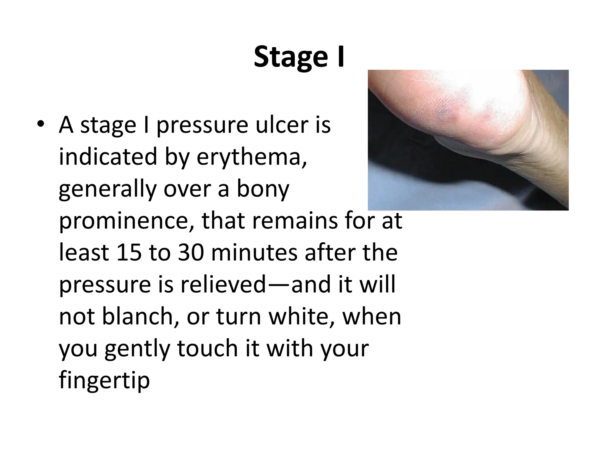 Pressure Ulcers A decubitus ulcer. Stages of Bedsore | PDF
