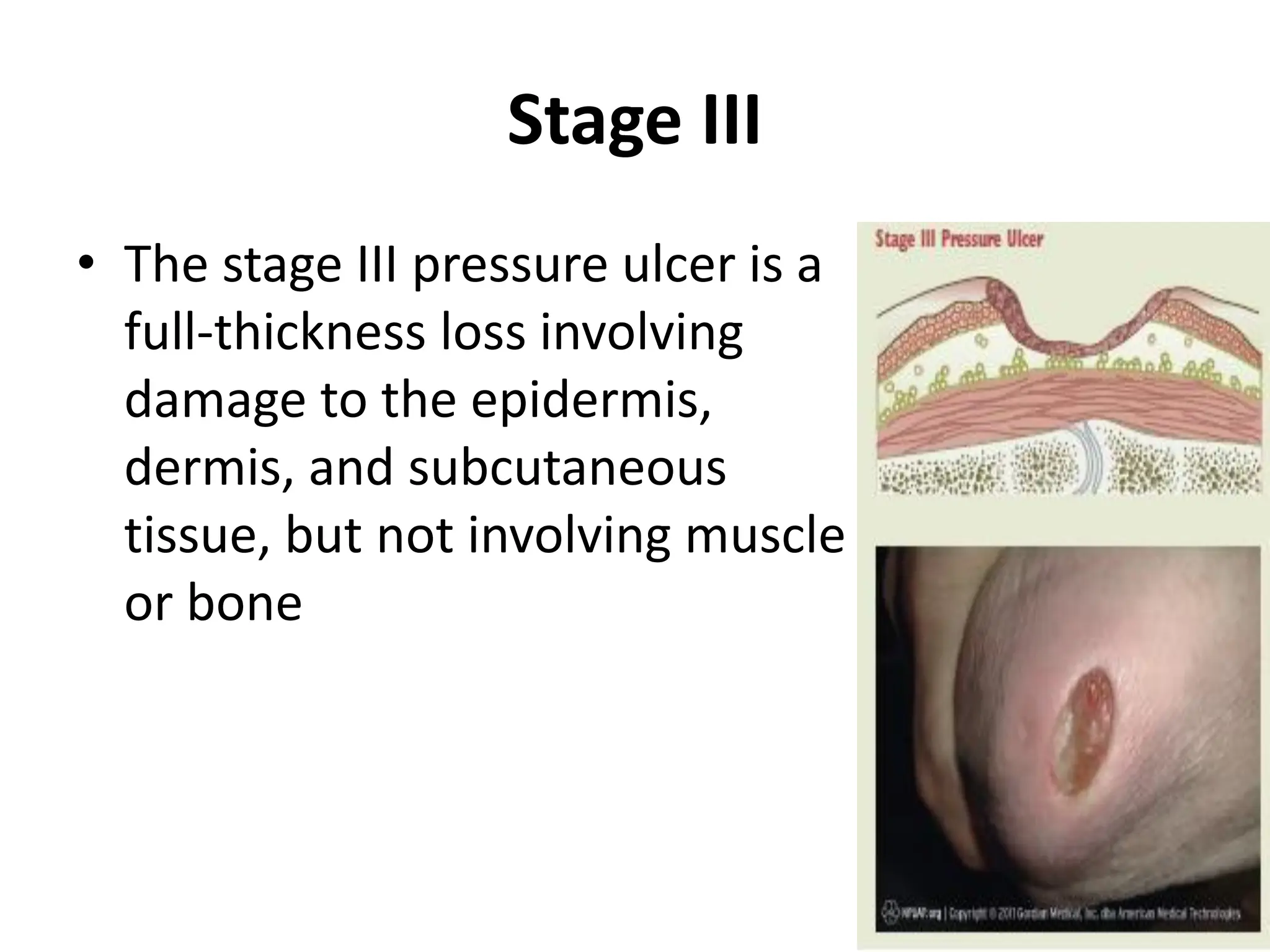 Pressure Ulcers A decubitus ulcer. Stages of Bedsore | PDF