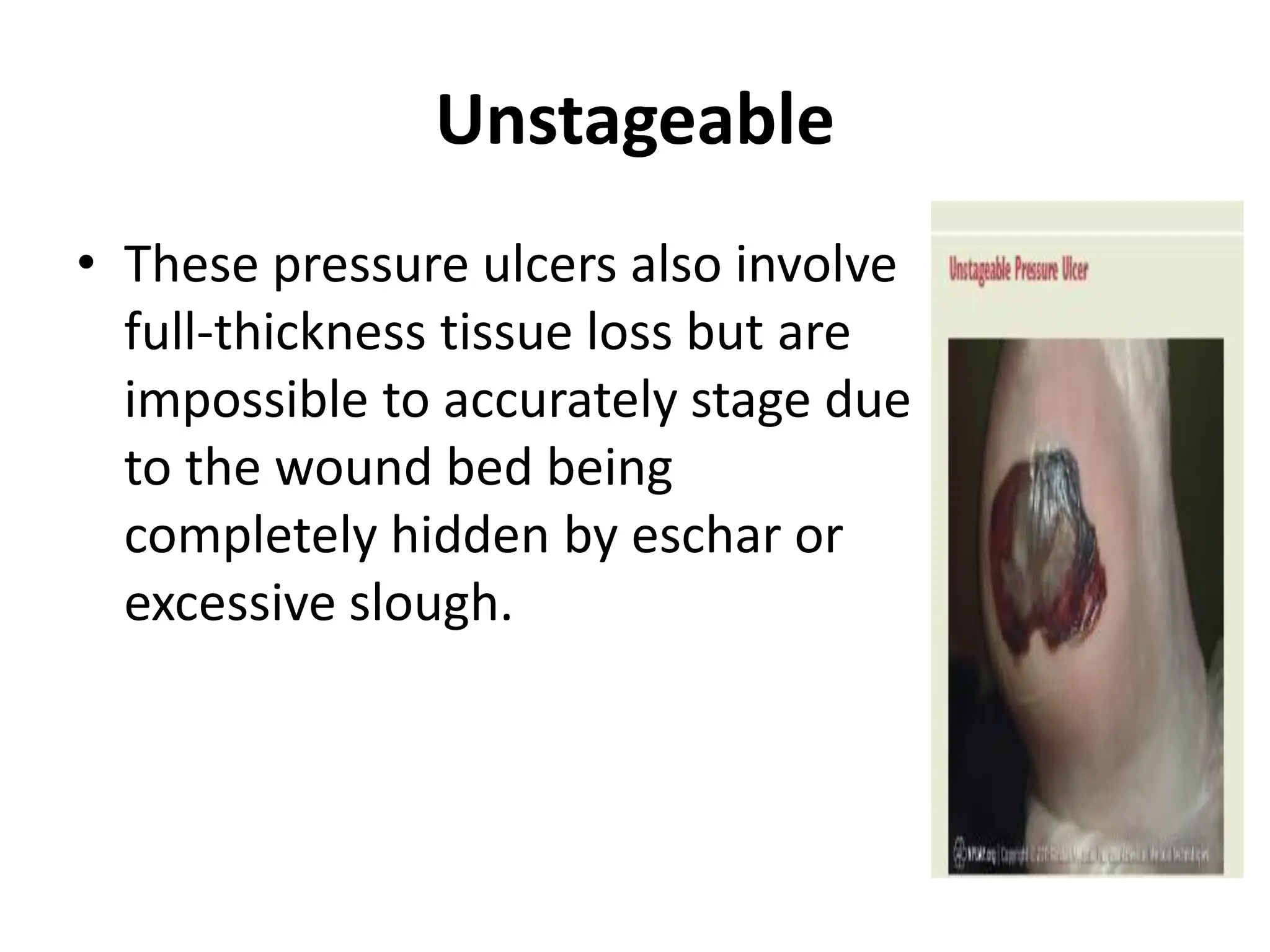Pressure Ulcers A decubitus ulcer. Stages of Bedsore | PDF