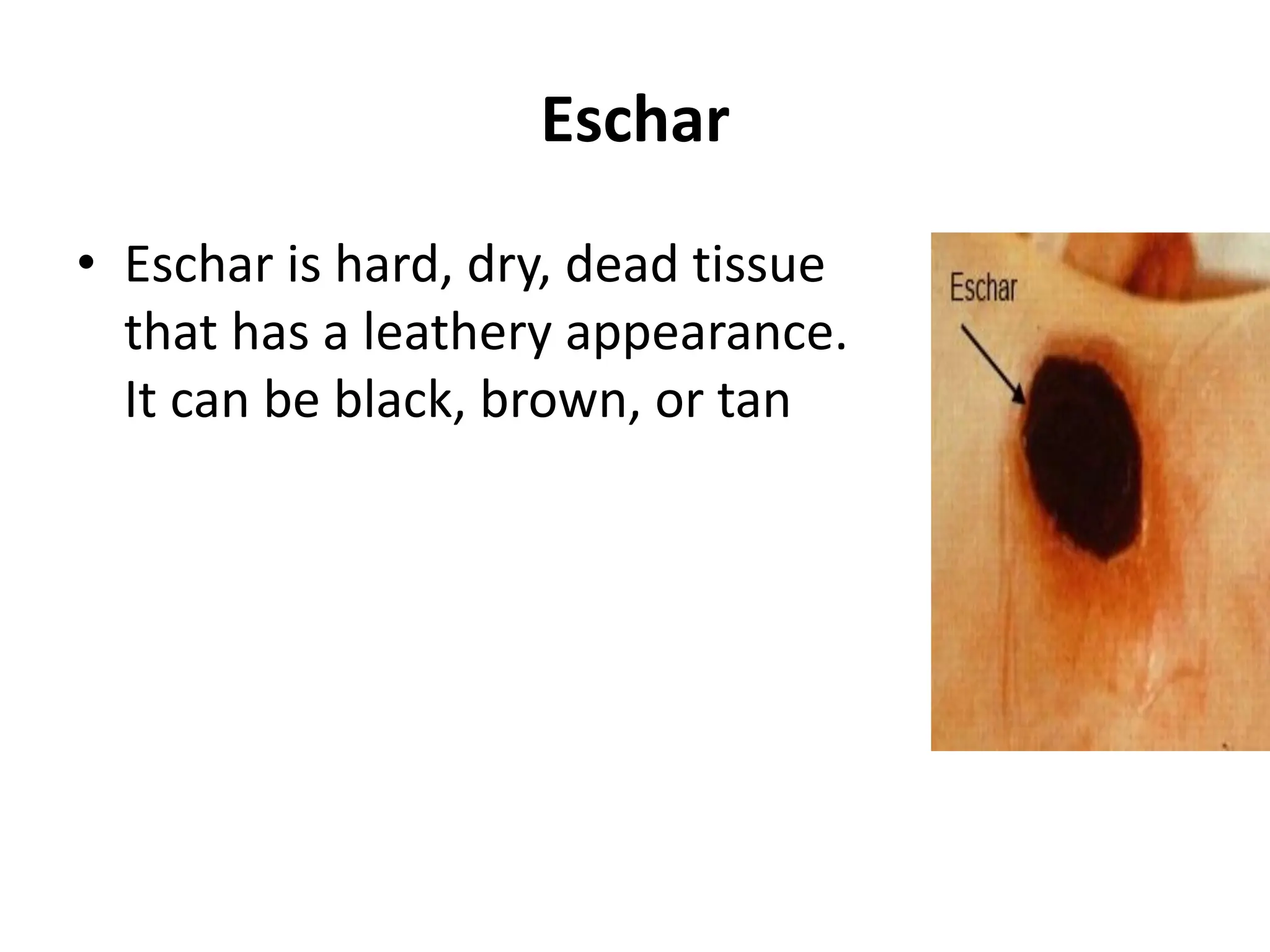 Pressure Ulcers A decubitus ulcer. Stages of Bedsore | PDF