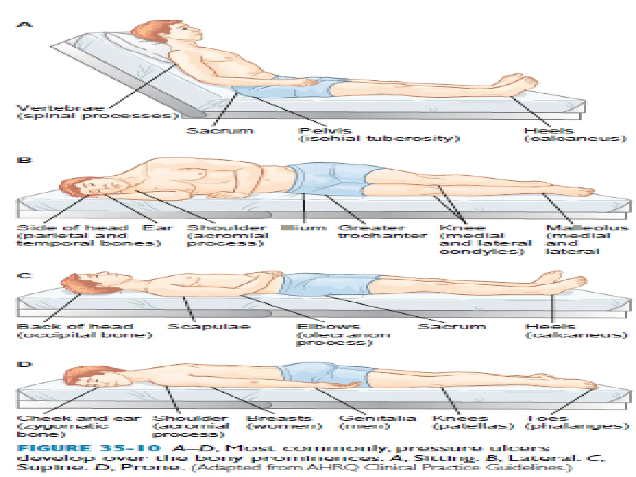 Pressure Ulcers A decubitus ulcer. Stages of Bedsore | PDF