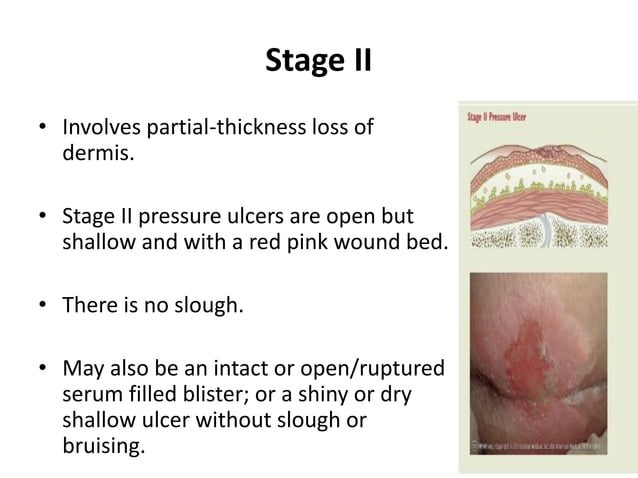Pressure Ulcers A decubitus ulcer. Stages of Bedsore | PDF | Death ...