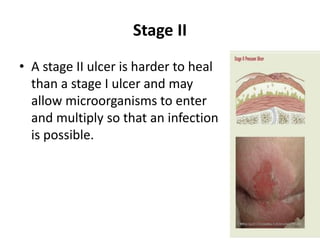 Pressure Ulcers A decubitus ulcer. Stages of Bedsore | PDF