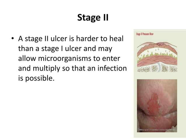 Pressure Ulcers A decubitus ulcer. Stages of Bedsore | PDF | Death ...