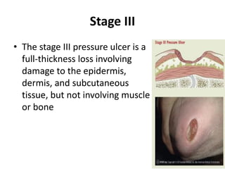 Pressure Ulcers A decubitus ulcer. Stages of Bedsore | PDF