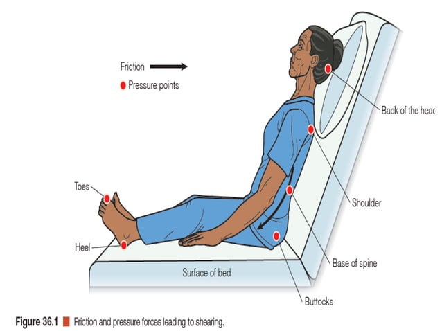 Pressure Ulcers A decubitus ulcer. Stages of Bedsore | PDF | Death ...