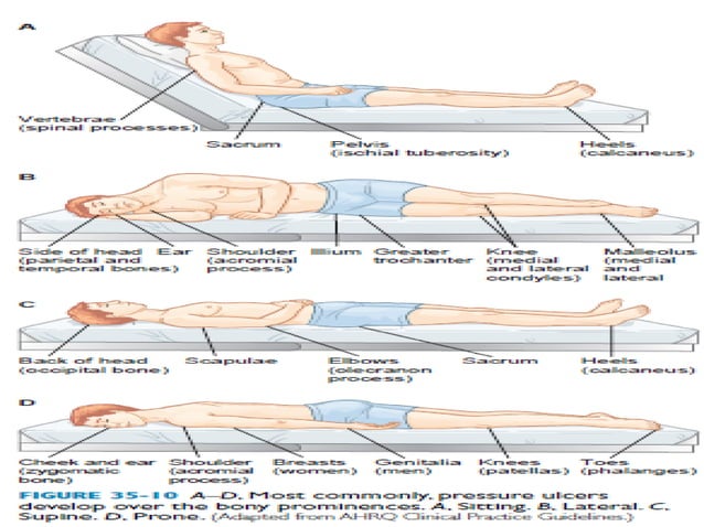 Pressure Ulcers A decubitus ulcer. Stages of Bedsore | PDF | Death ...