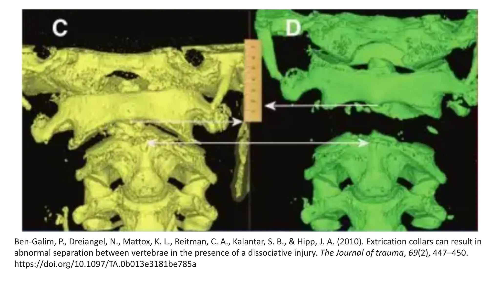 2024 Selective Spinal Motion Restriction in the 21st century | PDF