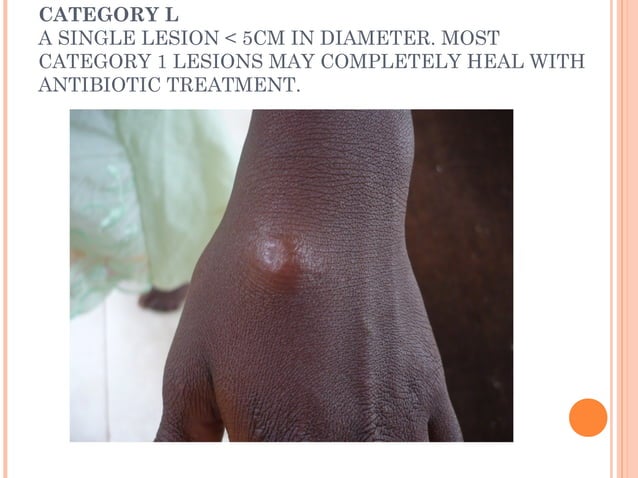 Presentation On Buruli Ulcer | PPT | Digestive Disorders | Diseases and ...