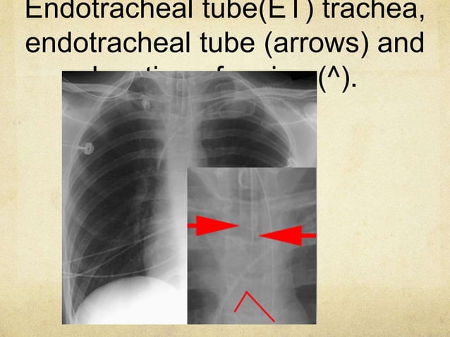 209415893-Endotracheal-tube-insertion-ppt.pptx