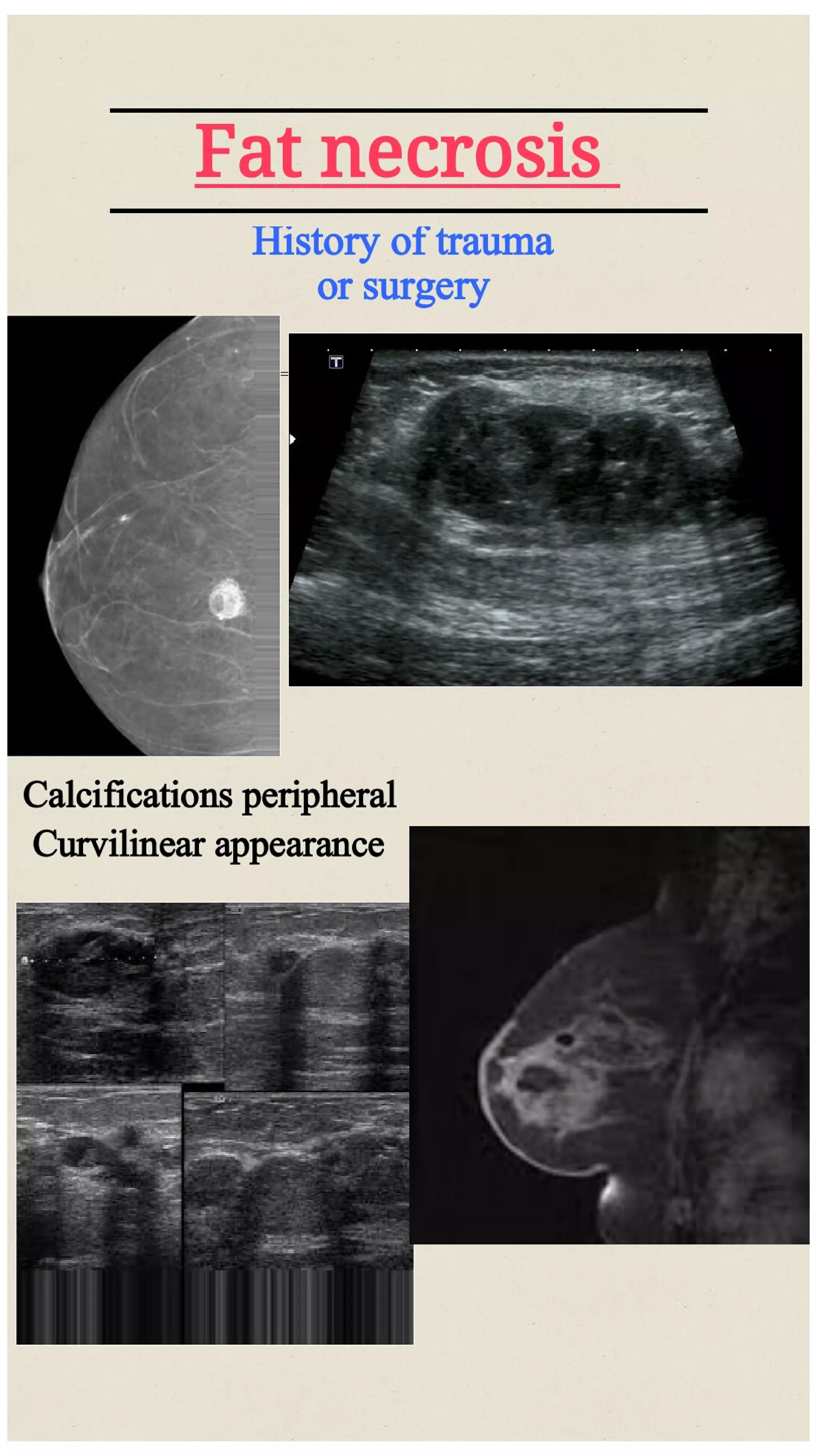 Cystic lesions of the breast | PDF