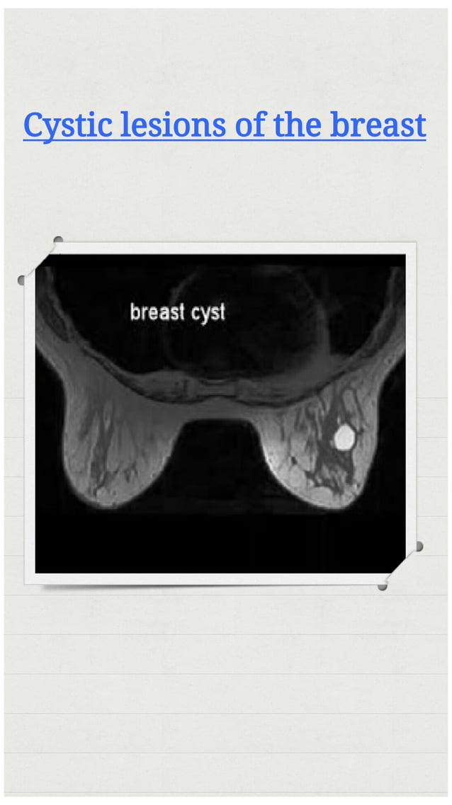 Cystic lesions of the breast | PDF
