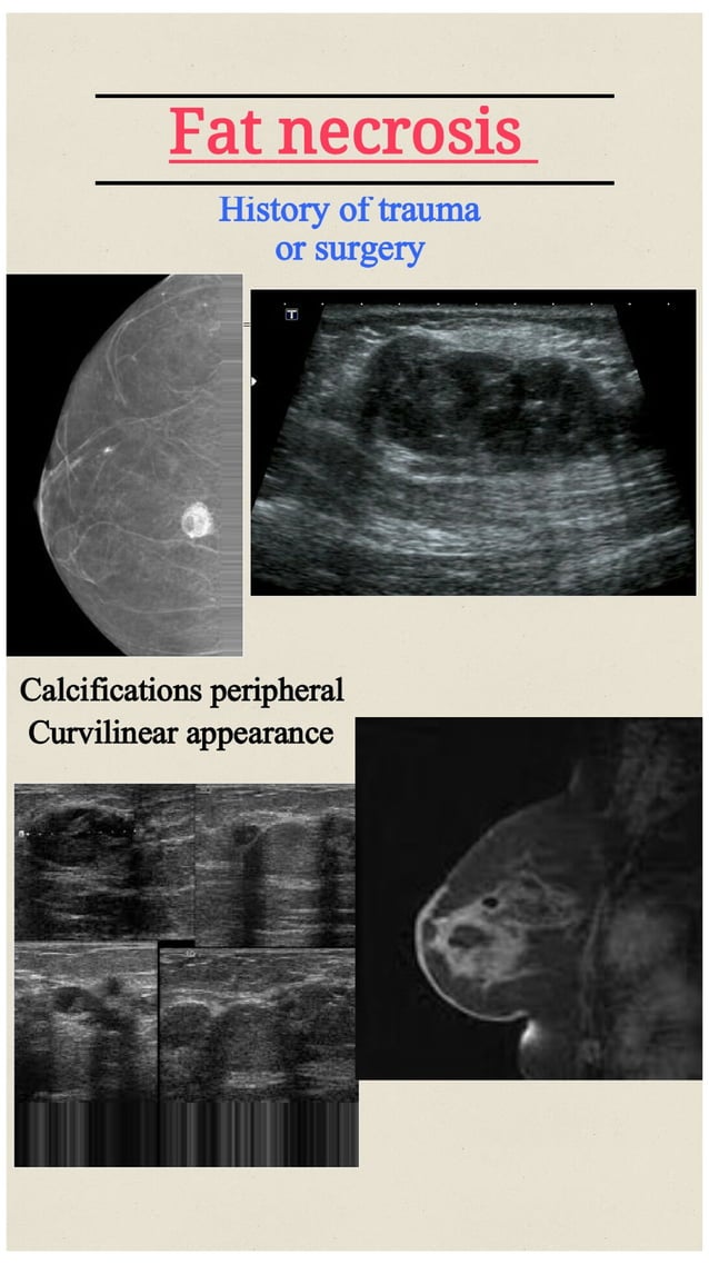 Cystic lesions of the breast | PDF