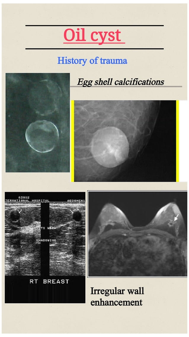 Cystic lesions of the breast | PDF