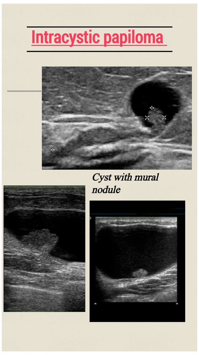 Cystic lesions of the breast | PDF