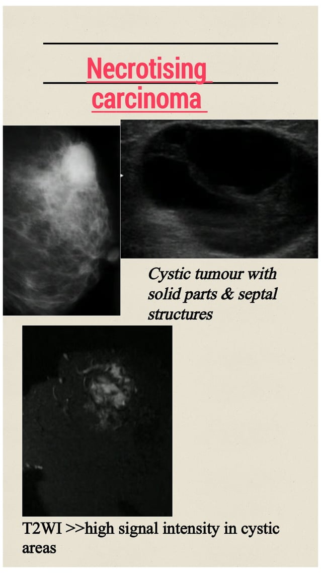 Cystic lesions of the breast | PDF