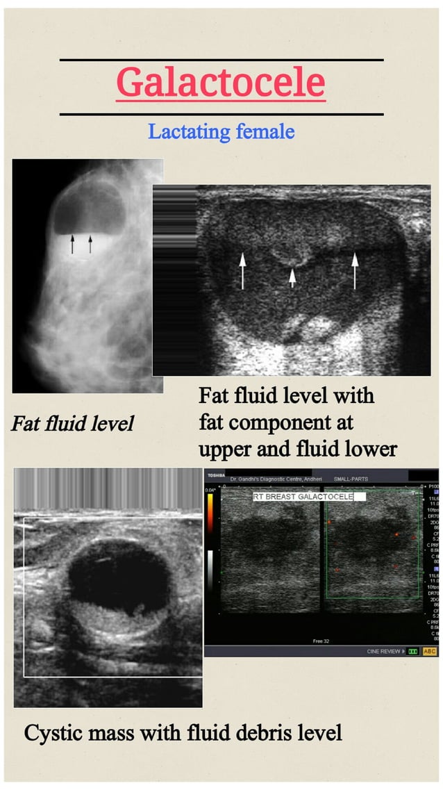 Cystic lesions of the breast | PDF