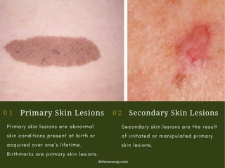 20 Common Skin Lesions | PPT