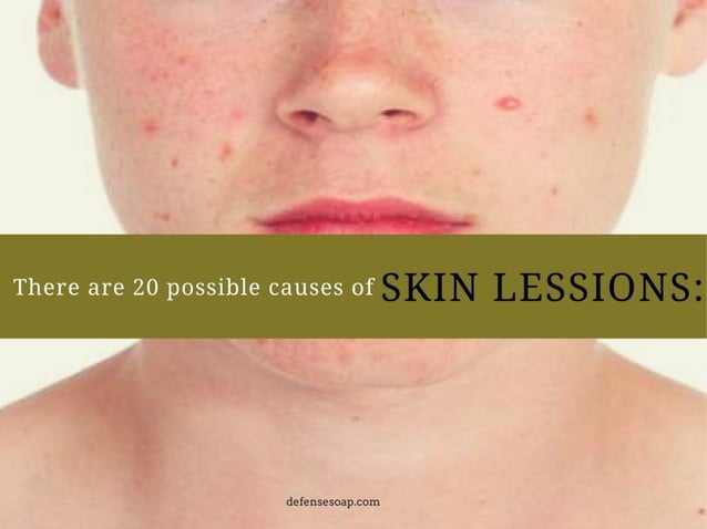 20 Common Skin Lesions | PPT