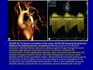 20 congenital heart disease Dr. Muhammmad Bin Zulfiqar | PPTX
