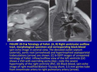 20 congenital heart disease Dr. Muhammmad Bin Zulfiqar | PPTX