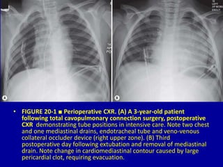 20 congenital heart disease Dr. Muhammmad Bin Zulfiqar | PPTX