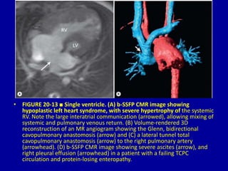 20 congenital heart disease Dr. Muhammmad Bin Zulfiqar | PPTX