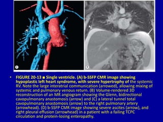 20 congenital heart disease Dr. Muhammmad Bin Zulfiqar | PPTX