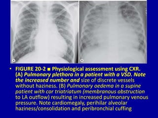 20 congenital heart disease Dr. Muhammmad Bin Zulfiqar | PPTX