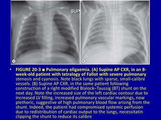 20 congenital heart disease Dr. Muhammmad Bin Zulfiqar | PPTX