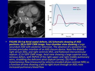 20 congenital heart disease Dr. Muhammmad Bin Zulfiqar | PPTX