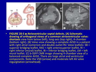 20 congenital heart disease Dr. Muhammmad Bin Zulfiqar | PPTX
