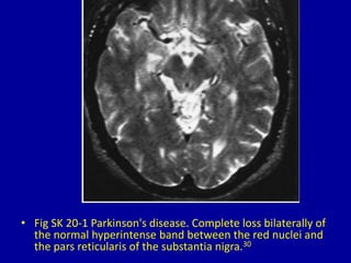 20 degenerative and metabolic disorders of the brain | PPT