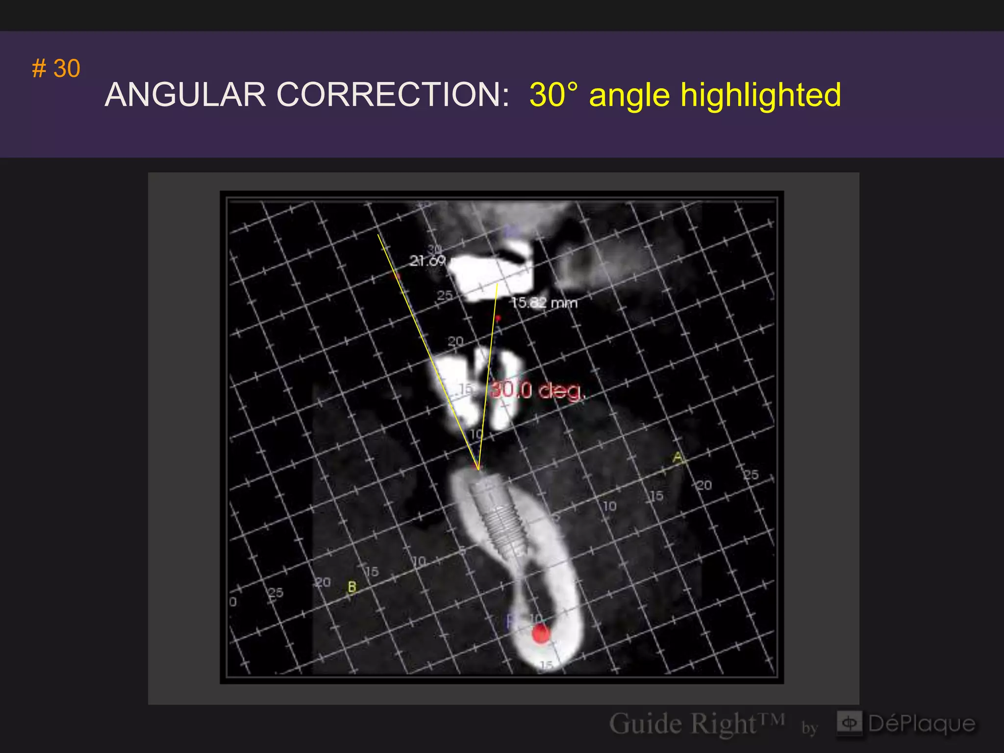 20 mandibular non parallel implant placement | PDF