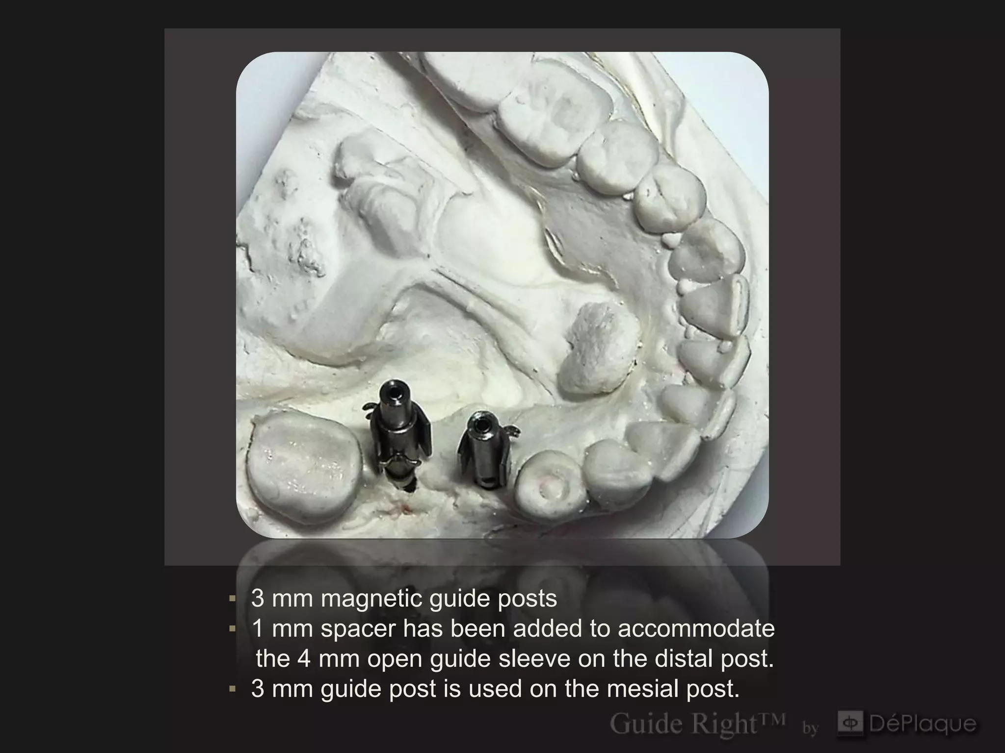 20 mandibular non parallel implant placement | PDF 20 mandibular non parallel implant placement | PDF