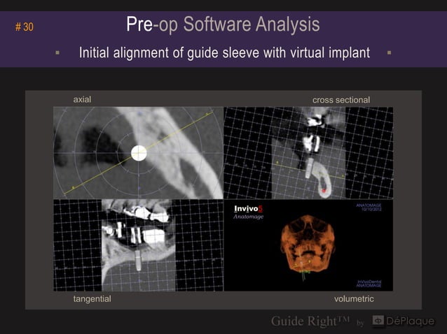 20 mandibular non parallel implant placement | PDF