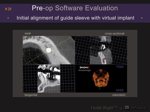 20 mandibular non parallel implant placement | PDF 20 mandibular non parallel implant placement | PDF