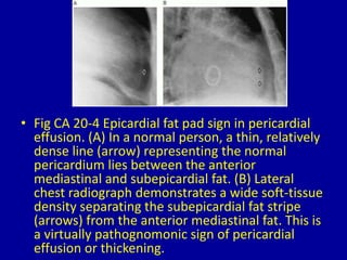 20 pericardial effusion | PPTX | Heart and Cardiovascular Diseases ...