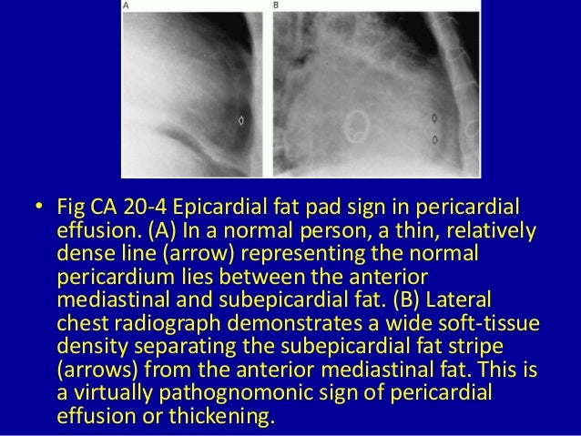20 pericardial effusion