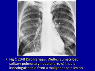 20 pulmonary disease with eosinophilia | PPTX