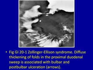 20 thickening of duodenal folds | PPTX