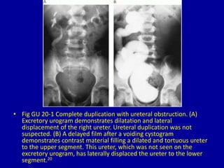 20 ureterectasis | PPT