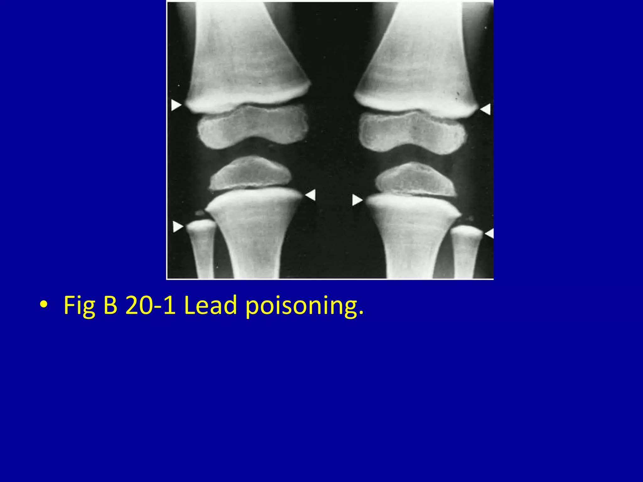 20 zones of increased density in the metaphyses | PPTX
