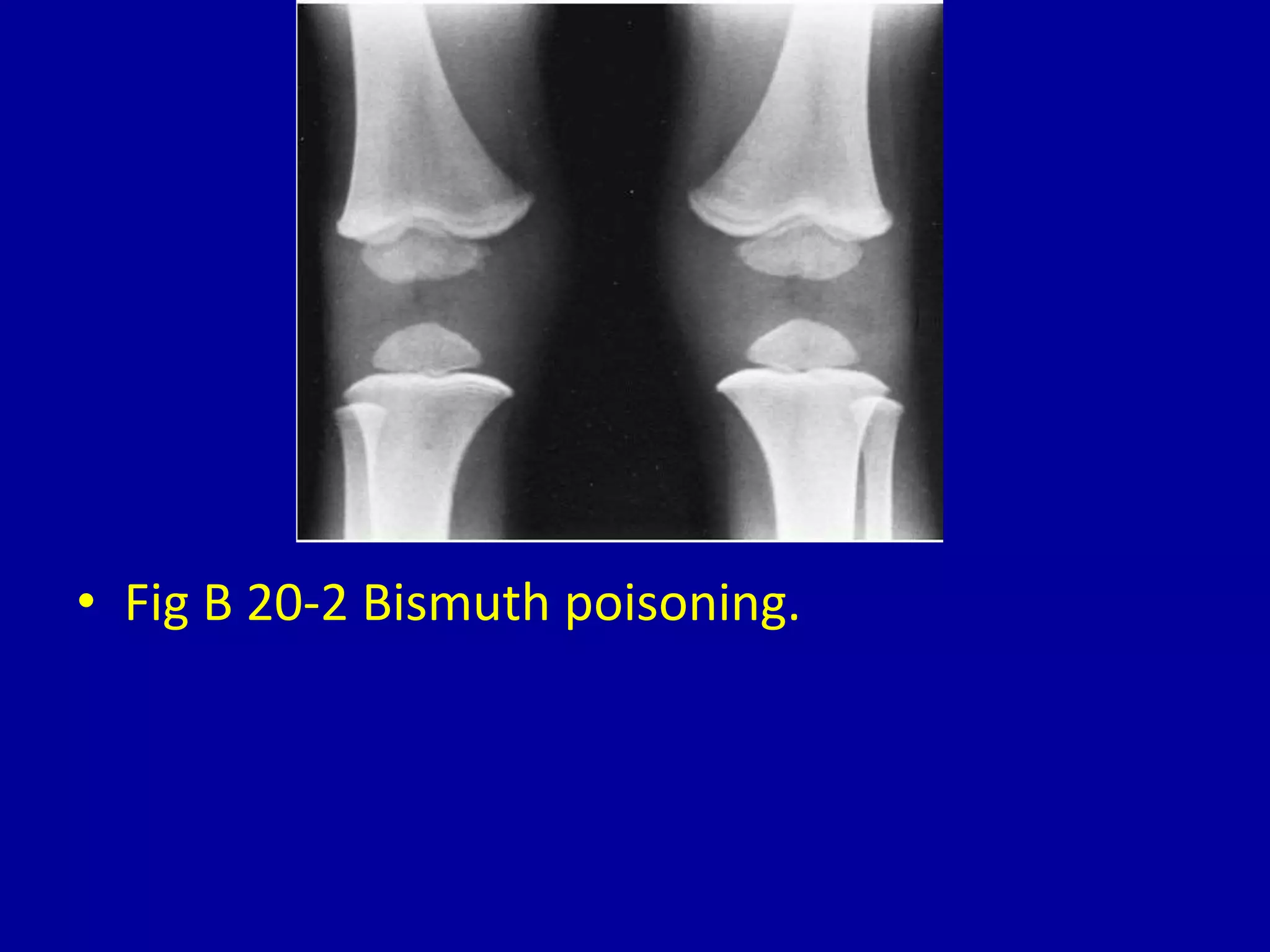 20 zones of increased density in the metaphyses | PPTX
