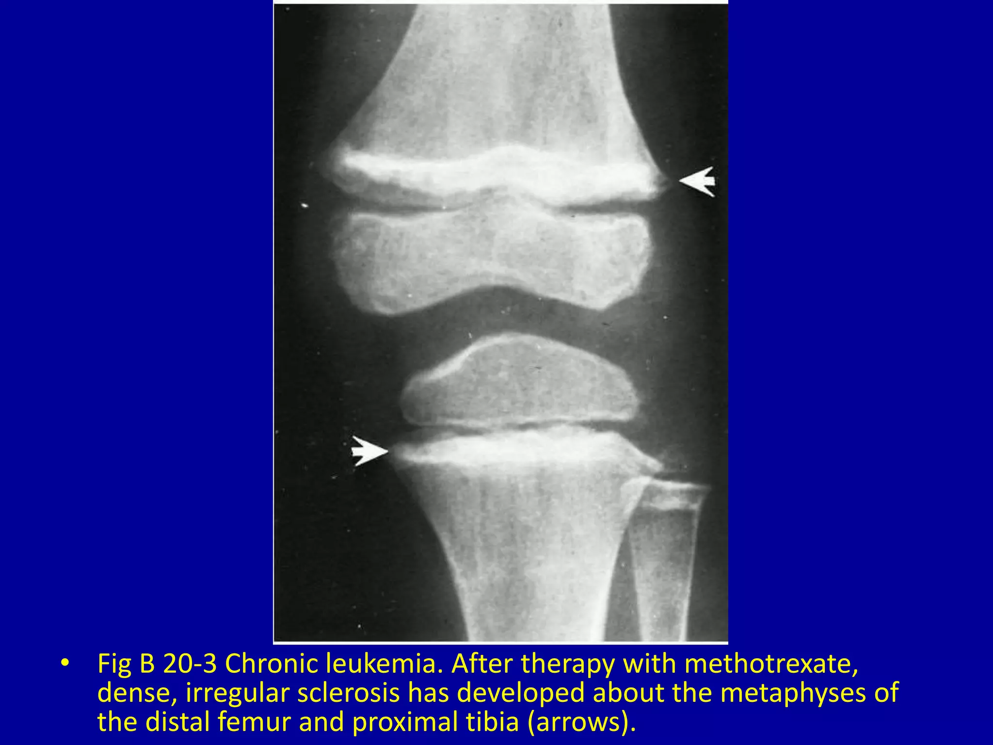 20 zones of increased density in the metaphyses | PPTX