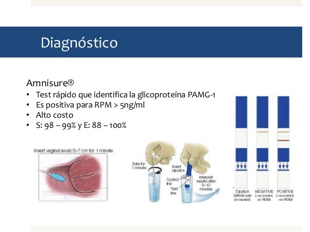 Rotura prematura de membranas