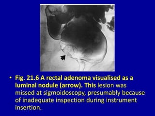21 DAVID SUTTON PICTURES THE LARGE BOWEL | PPT